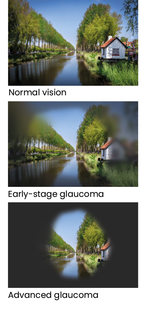 The treatment of glaucoma